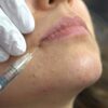 How to resolve and avoid lip filler lumps | Dr Tim Pearce
