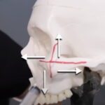 Injecting the zygoma, safety advice, injection points | Dr Tim Pearce