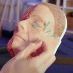 Tutorial: injection points for cheek filler | Dr Tim Pearce